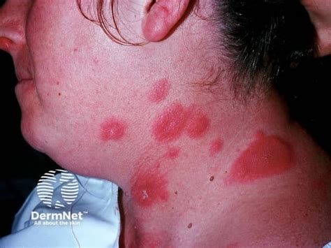 Acute Febrile Neutrophilic Dermatosis Sweet Syndrome An Overview