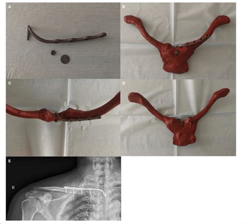 Sternoclavicular Joint Specific Plate A And Its Appearance Fixed In
