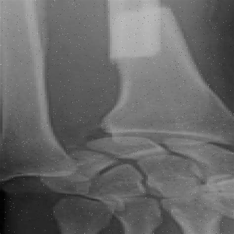 Human Bone Fracture Detection Object Detection Dataset V1 2024 02 22 1028am By Fracturedetection