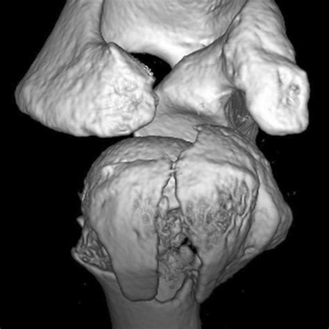 Pdf Head Split Fractures Of The Proximal Humerushead Split Frakturen