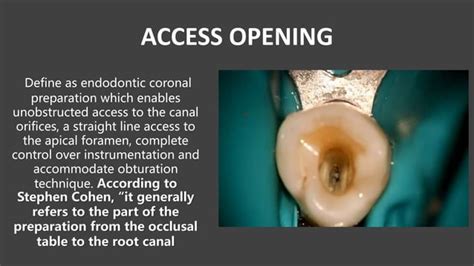 Endodontic Access Cavity For Anterior Teeth Dr Ali Mohammed Pptx
