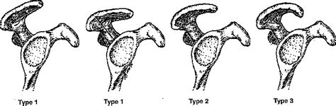 Arthroscopic Acromioplasty Orthopedic Clinics