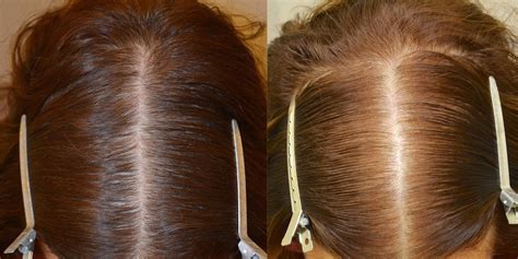 Finasteride Females Before And After Photos Hair Restoration Of The