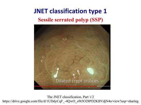 Jnet Classification Of Colo Rectal Polyps Pptx