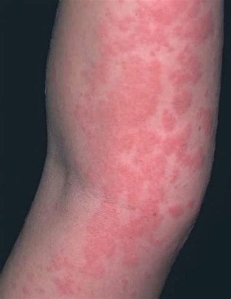 Sun Allergy Everything You Need To Know Skin Care Top News