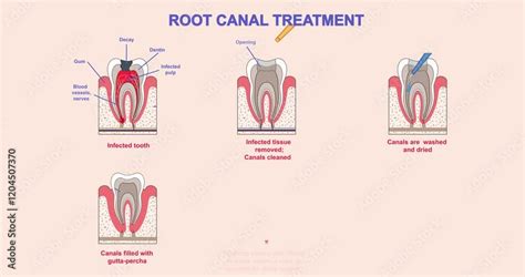 Root Canal Treatment Moving Banner With Medical Infographics And