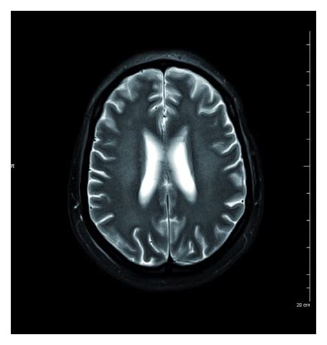 A Dwi Diffusion Weighted Images Bilateral And Symmetric Diffusion