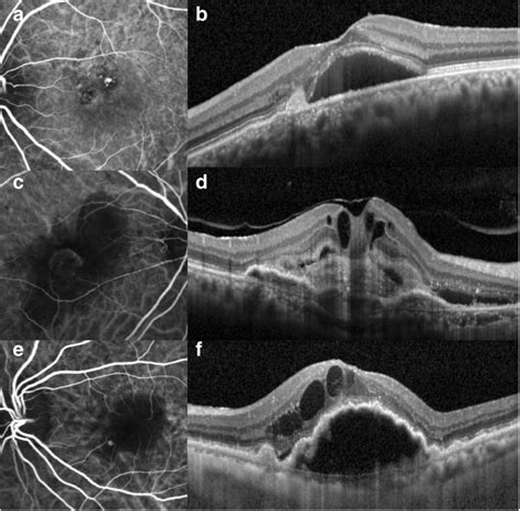 Representative Cases Classified As Polypoidal Choroidal Vasculopathy