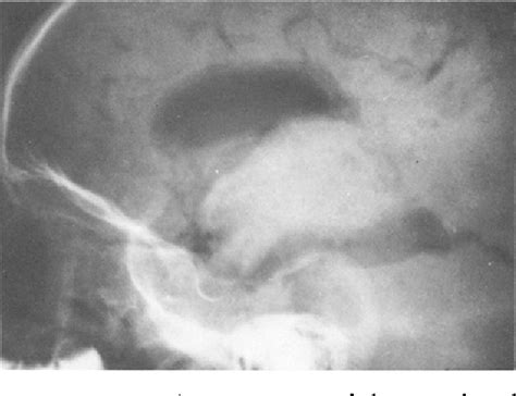 Figure 1 From Pubertas Praecox In Craniopharyngioma Case Report