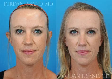 Reconstructive 2 Sand Plastic Surgery Of Spokane