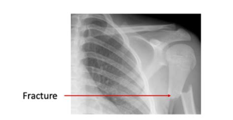 Fracture Flashcards Quizlet