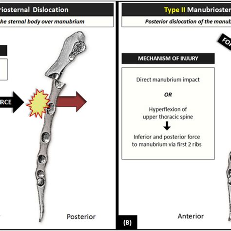 Pdf Manubriosternal Joint Dislocation Due To Blunt Force Trauma