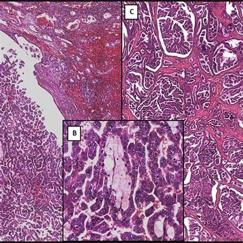 Complication Rates In The Open Partial Nephrectomy Series Download Scientific Diagram