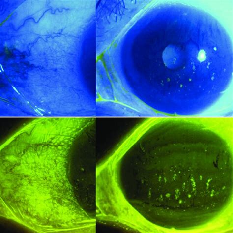 The Use Of A Yellow Filter Allows Assessment Of Conjunctival Staining Download Scientific