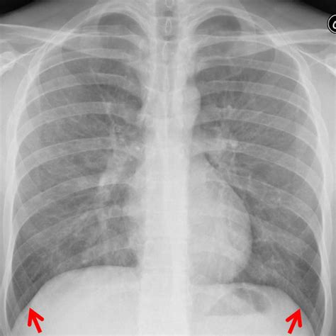 Bilateral Nodular Consolidation In A Human Immunodeficiency Virus Download Scientific Diagram