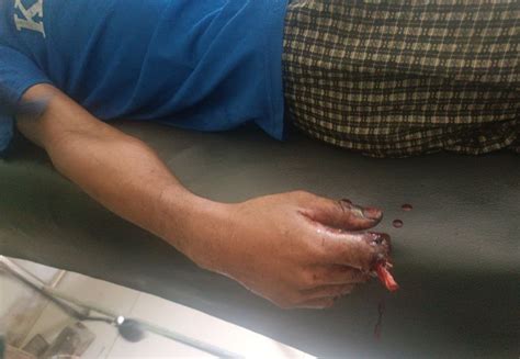 တောင်ကုတ်မာ စစ်ကျန်မိုင်း ပေါက်ကွဲလို့ အမျိုးသားတယောက် ဒဏ်ရာရ Arakan Princess Media