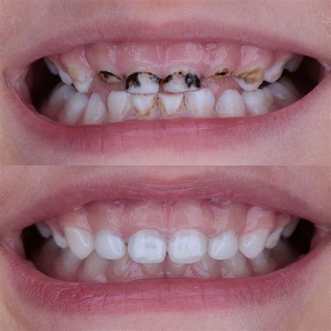 Cosmetic Flowable Composite Live