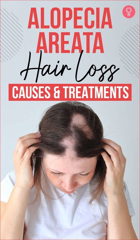 Alopecia Areata Hair Loss — Causes Symptoms Treatments Artofit
