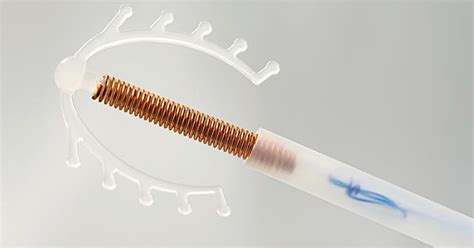 Mirena Iud Removal Artofit