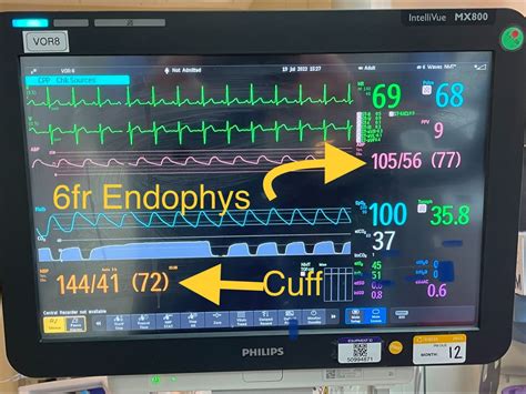 Steve Leonard Rt R Vi Ci On Linkedin This Was A Pcom Aneurysm Embolization Done In Nashville