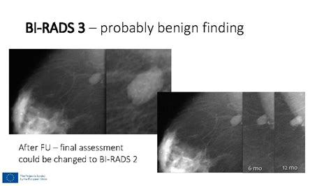 Birads Classification In Mammography Dr Egle Jonaitiene Dr