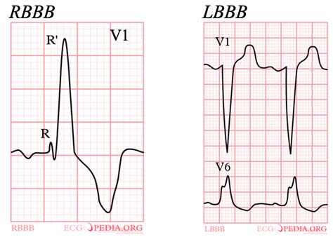 Ecg Interpretation Rate Rhythm Cardiac Axis Teachmepaeds