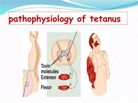Tetanus Pptx