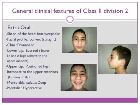Class Ii Division 2 Malocclusion