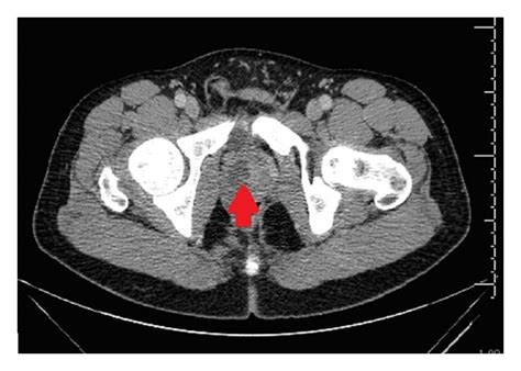 A Initial Ct Scan Left Showing 23 Cm Prostate Abscess In The Right