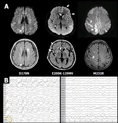 Cjd Profiles Of Mri And Eeg From Probable Cjd Patients A Brain Mris
