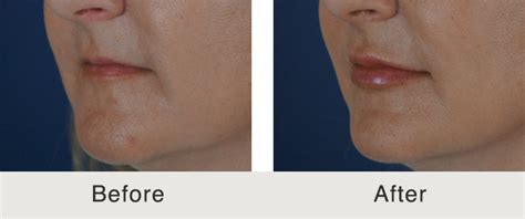 Lip Fillers Carolina Facial Plastic Surgery Carolina Facial Plastic
