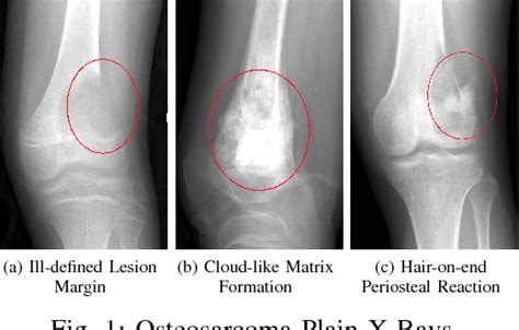 Figure 1 From Osteosarcoma Patients Classification Using Plain X Rays And Metabolomic Data