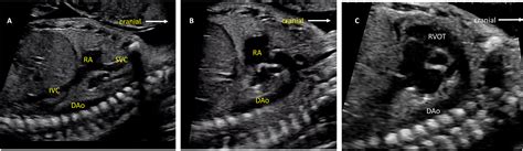 Guidelines And Recommendations For Performance Of The Fetal Echocardiogram An Update From The