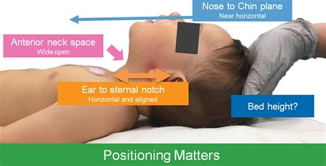 During Intubation Chbc