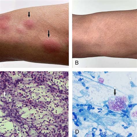Nodule And A Papule On Scrotum Download Scientific Diagram