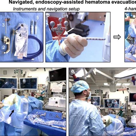 Intraoperative Control Imaging For Hematoma Detection The Preoperative