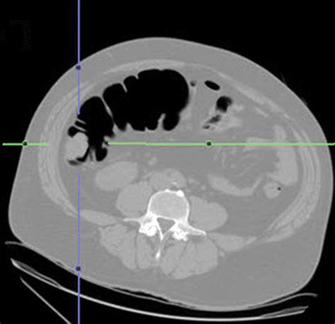 Clinical Value Of Ct Colonography Versus Preoperative Colonoscopy In