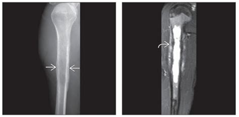 Ewing Sarcoma Primitive Neuroectodermal Tumor Pnet Basicmedical Key