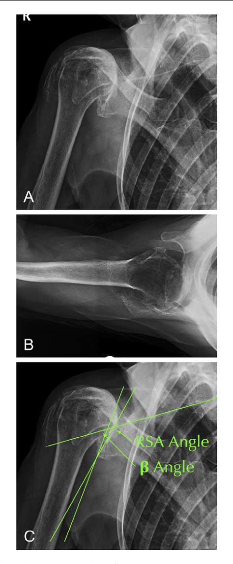 Figure 1 From Structural Glenoid Grafting During Primary Reverse Total Shoulder Arthroplasty