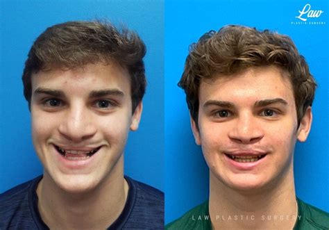 Jaw Surgery Before And After Photos Law Plastic Surgery