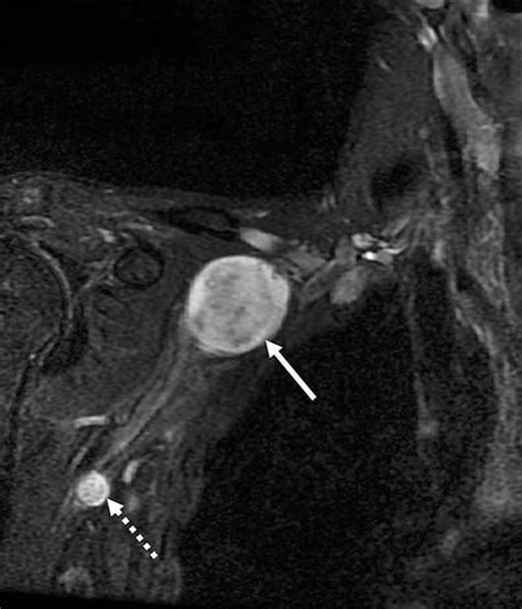 Imaging Brachial Plexus Pathology Applied Radiology