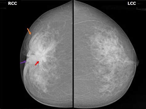 Atlas Of Breast Cancer Early Detection