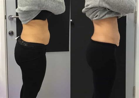 Hifu Before And After Results Vie Aesthetics