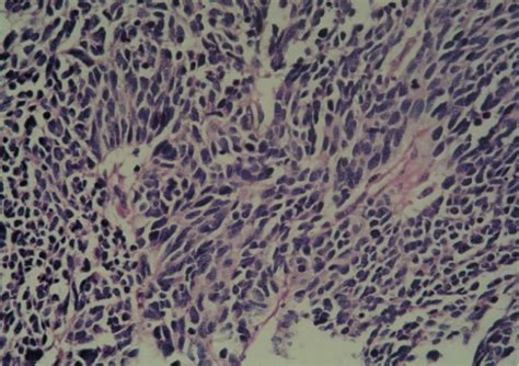 Histology Of The Breast Tumor Tissue Note Tumor Predominantly