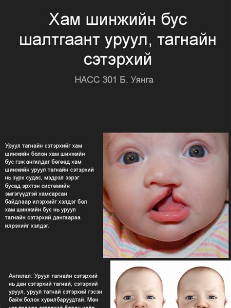 Хам шинжийн бус шалтгаант уруул тагнайн сэтэрхий Pdf