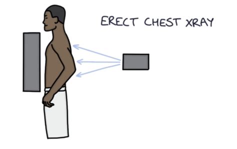 Pneumothorax Flashcards Quizlet