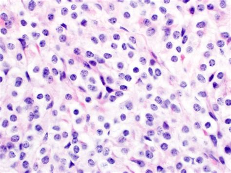Pathology Outlines Neuroendocrine Tumor