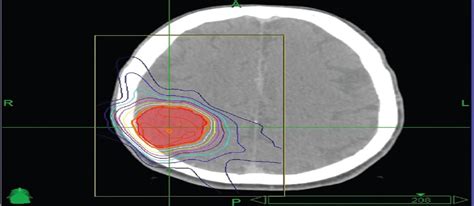 Fractionated Stereotactic Radiosurgery For The Treatment Of Journal Of Cancer Research And