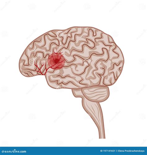 Human Brain Diseases Of The Brain Nervous System Vector Illustration Royalty Free Stock