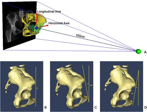 Drrs With Different Amounts Of Pelvic Tilt A Schematic View Of Drr